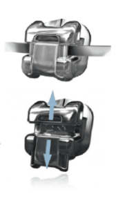 Damon Metal Braces | Bovenizer & Baker Orthodontics
